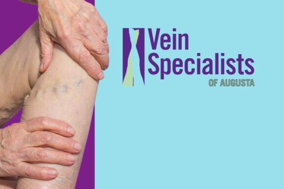 VenClose® RFA : Varicose Vein Treatment in Augusta